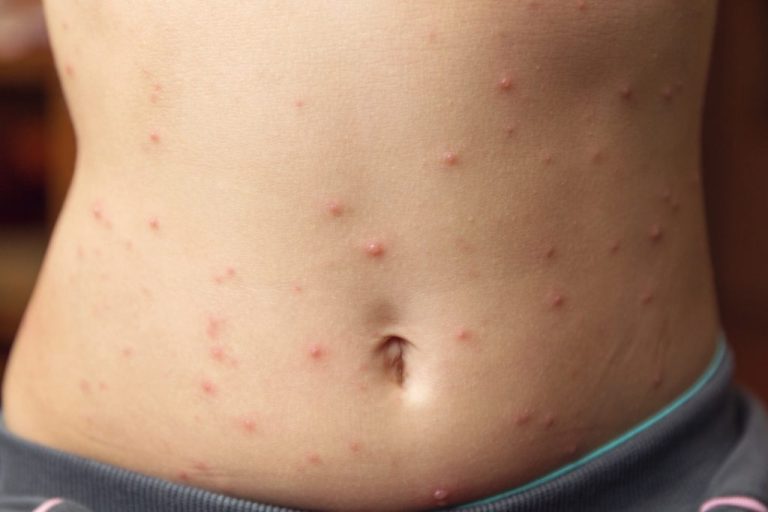 Bouton de varicelle photo : les identifier et les traiter
